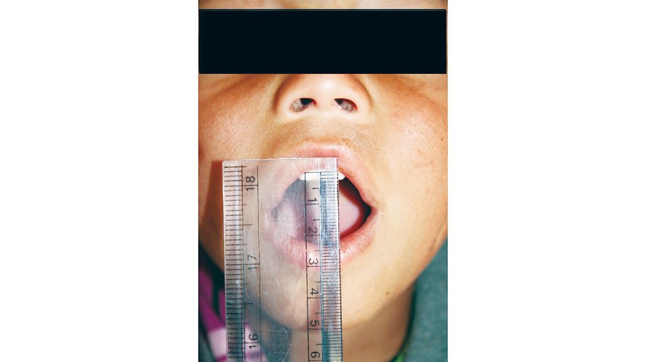 How to diagnose trismus (part 4) - Bangladesh Post